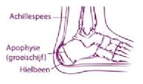 Sportmedisch advies : Hielpijn, hoe ontstaat het en hoe raak je het ...